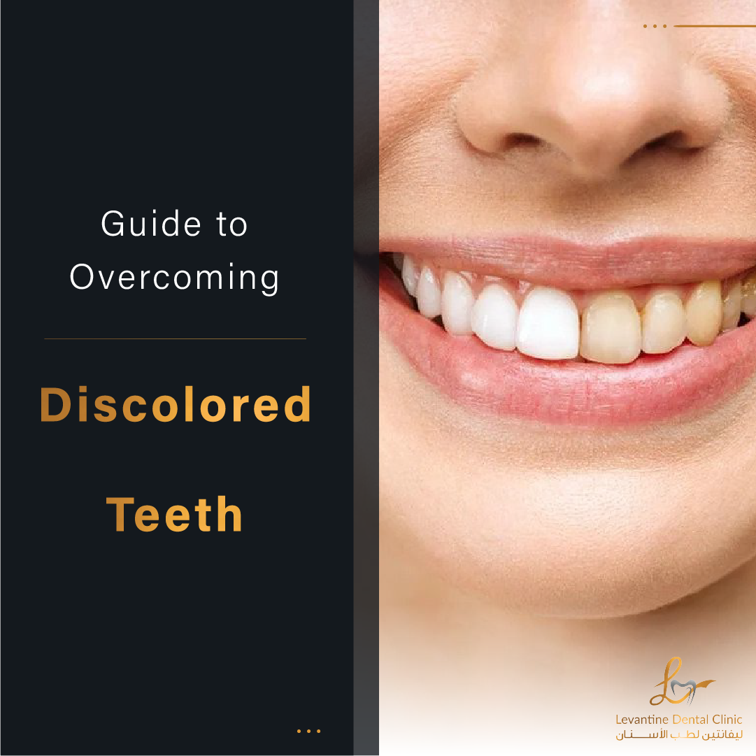 Comprehensive Guide To Overcoming Discolored Teeth